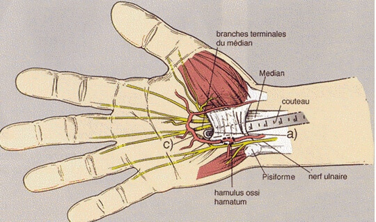 Le syndrome du canal carpien : halte à la compression du nerf médian